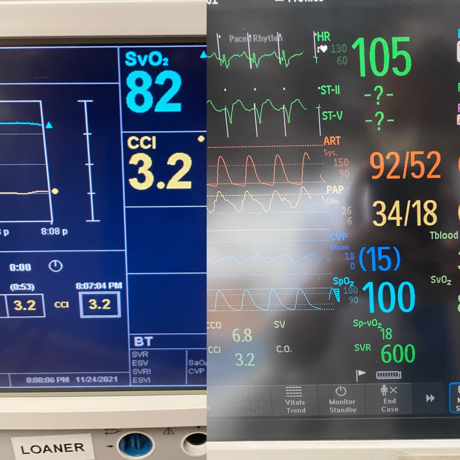 Recovering CABG & Cardiac/Heart Surgery Patients in the CVICU